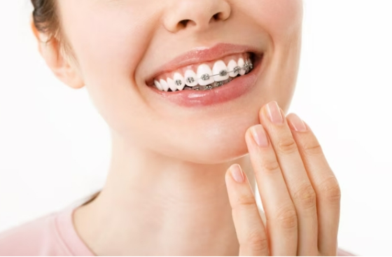 บริการจัดฟันแบบโลหะ ด้วยทันตแพทย์มืออาชีพ | Dentplease Clinic