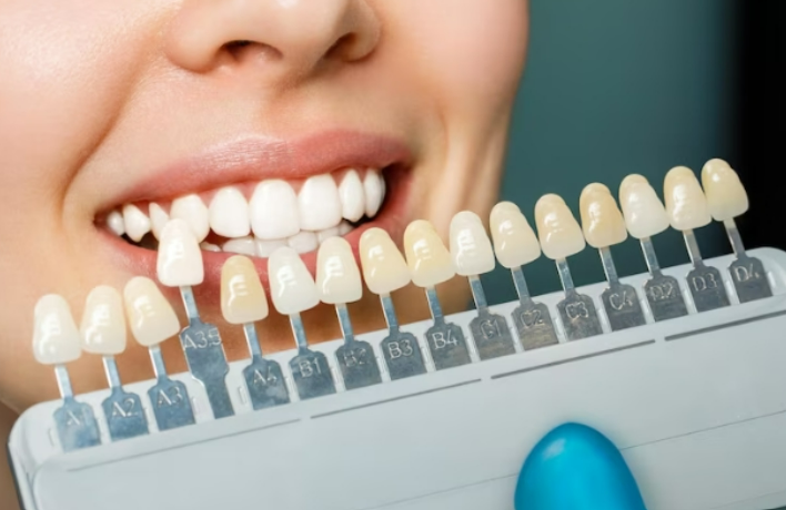 บริการเคลือบฟันวีเนียร์ ด้วยทันตแพทย์มืออาชีพ | Dentplease Clinic