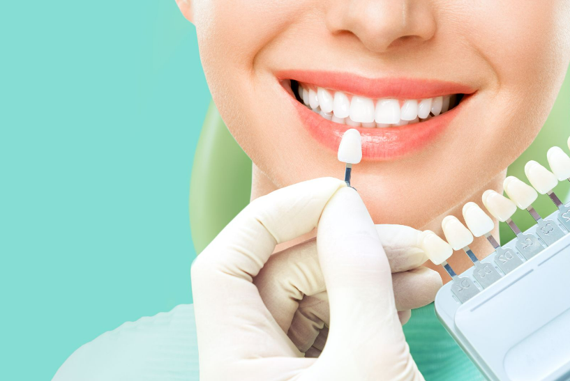 บริการเคลือบฟันวีเนียร์ในช่องปาก ด้วยทันตแพทย์มืออาชีพ | Dentplease Clinic